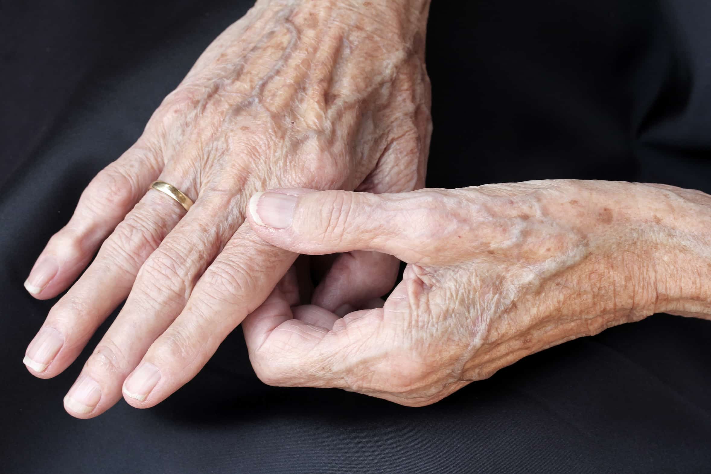 Pigmentflecken - Altersflecken - Lentigo - Cosmacon