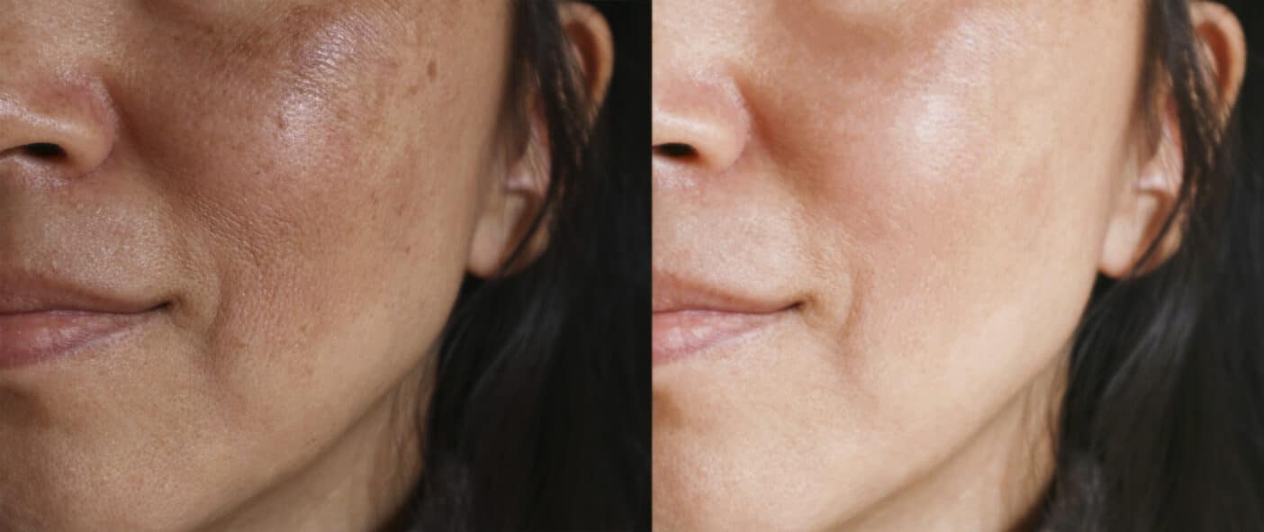Brightening - Glow - dark spots - Cosmacon