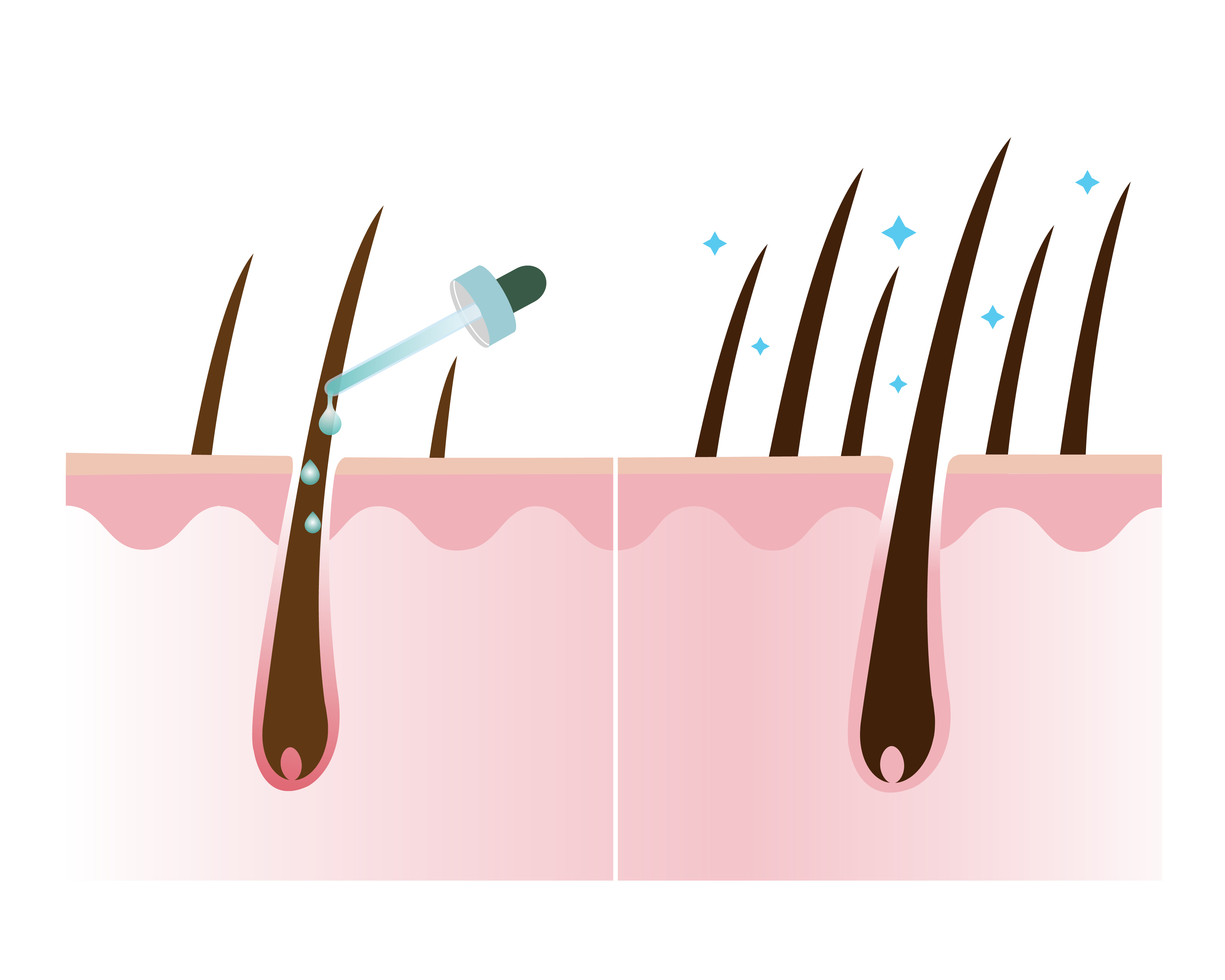 Hair thickening with azelaic acid - Cosmacon