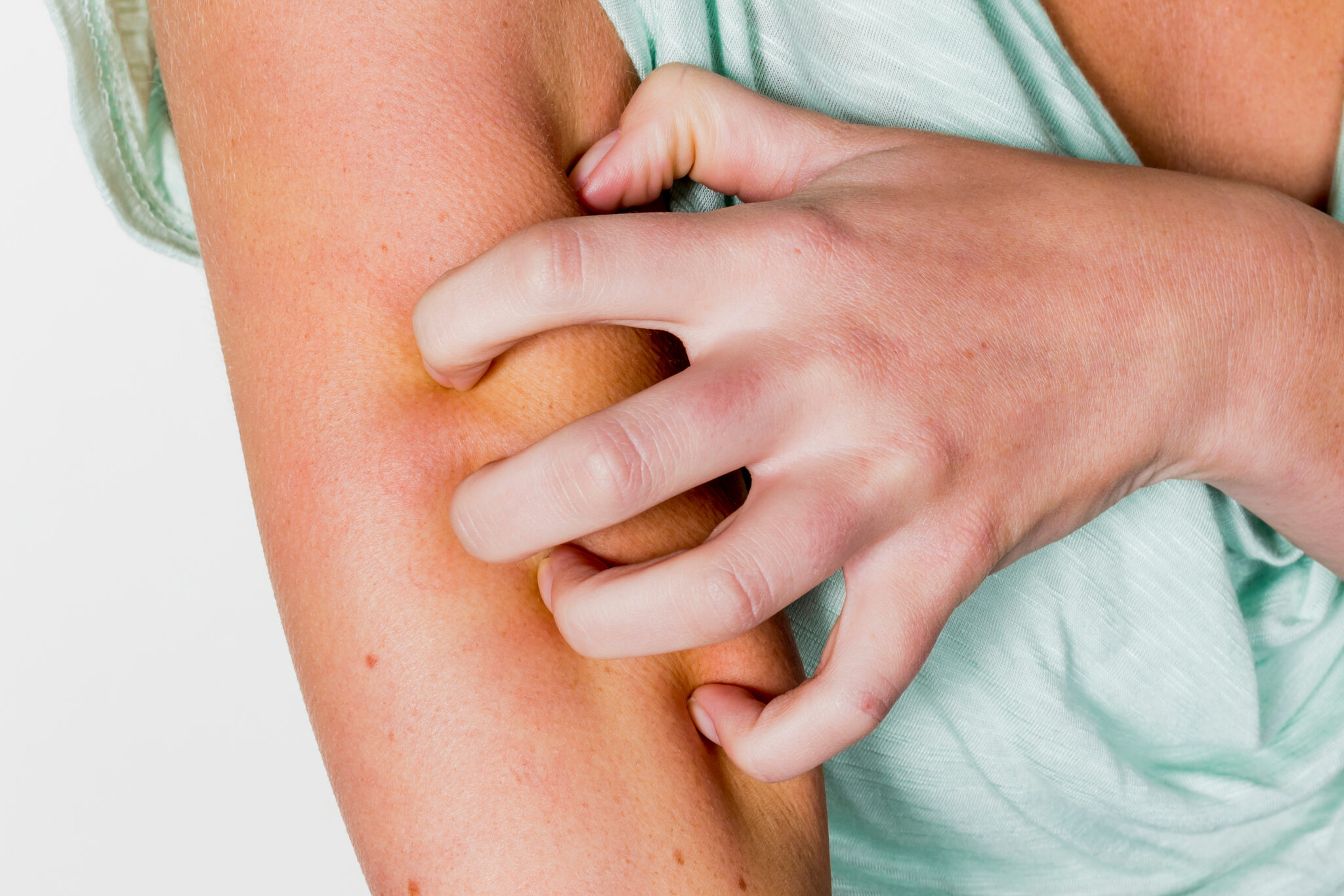 Allergy prevention: Why skin protection needs to start earlier today ...